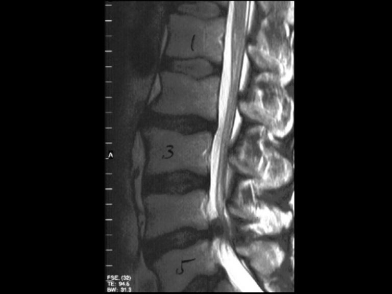 Bandscheibenvorfall L3/L4 und L4/L5 - Symptome und Befunde